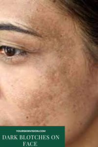 Dark Blotches On Face: Causes, Treatments, And Remedies