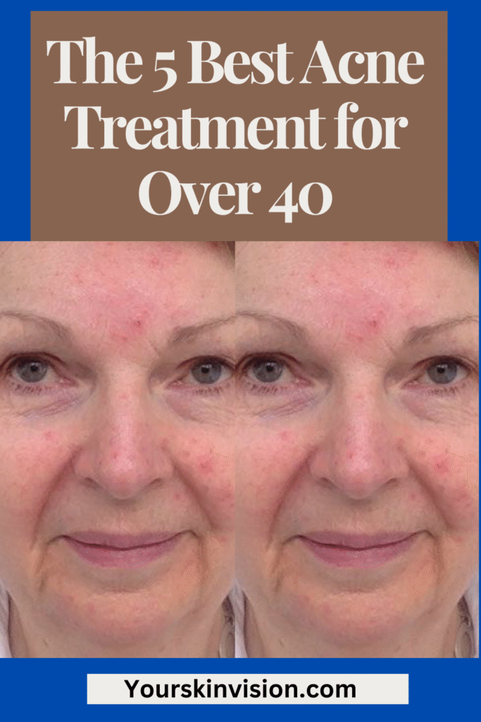 The 5 Best Acne Treatment for Over 40: Derms-Backed Solutions