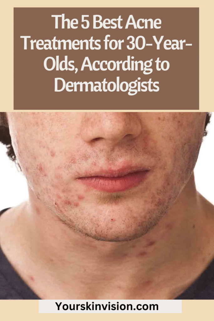 The 5 Best Acne Treatments for 30-Year-Olds, According to Derm