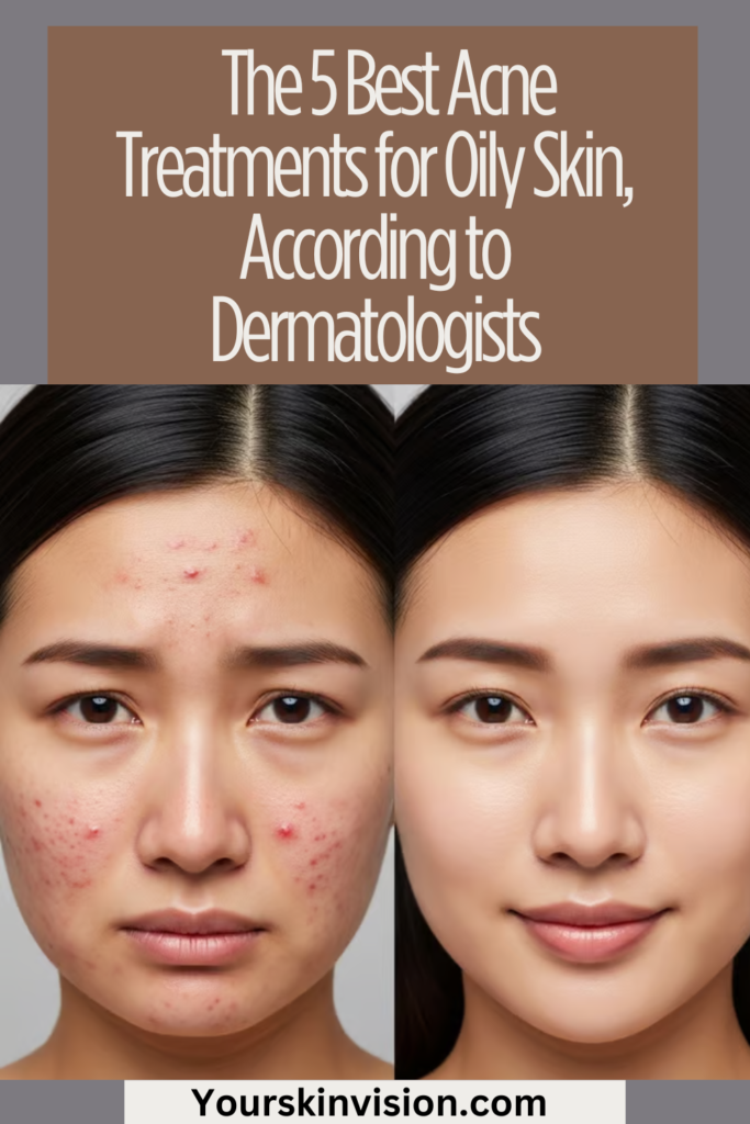 5 Best Acne Treatments for Oily Skin, According to Dermatologists
